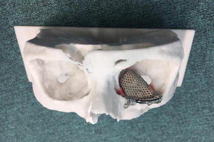 Surgeons use 3D Systems' software for complex fracture | Halldale Group